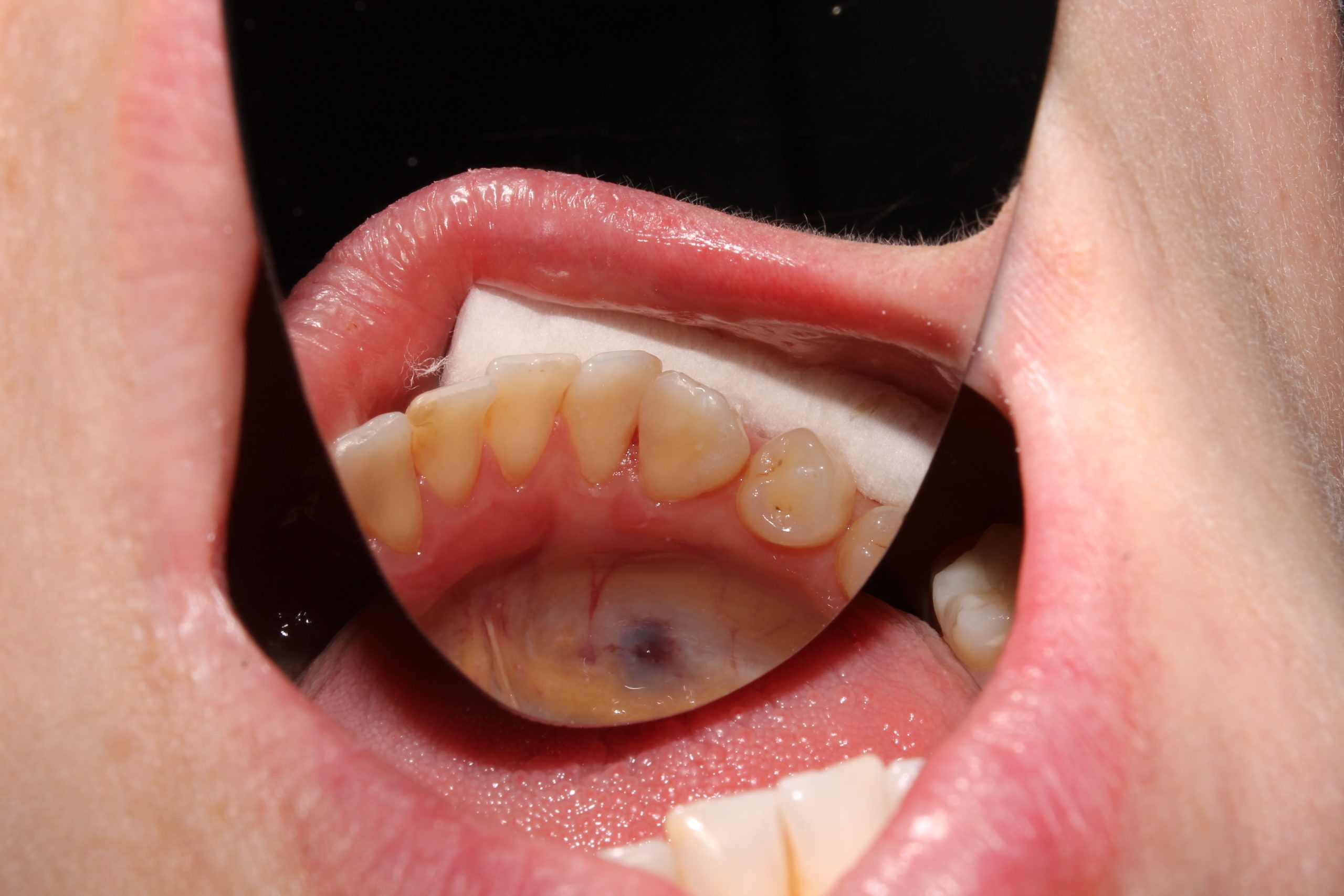 Oral Infections: How to Recognize and Treat Symptoms - Just Smilez Dental